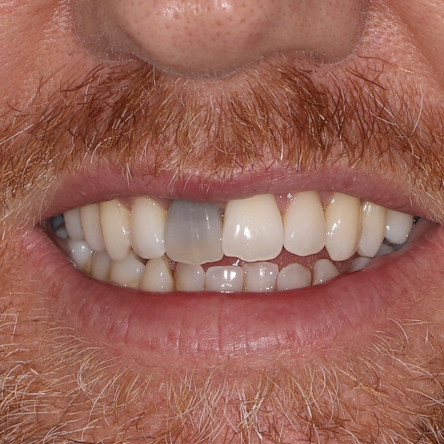 front tooth crown