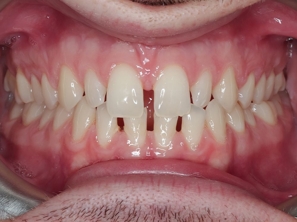 labial frenectomy code