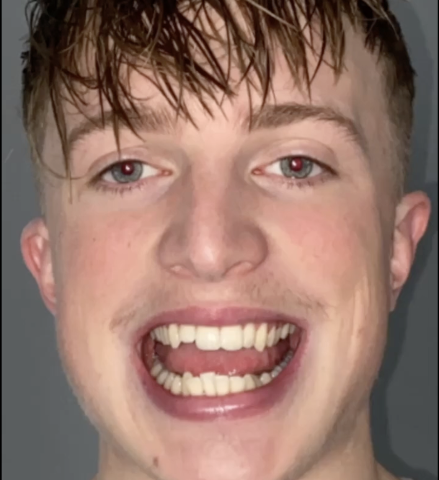 Open Bite - Symptoms, Causes And Orthodontic Treatments