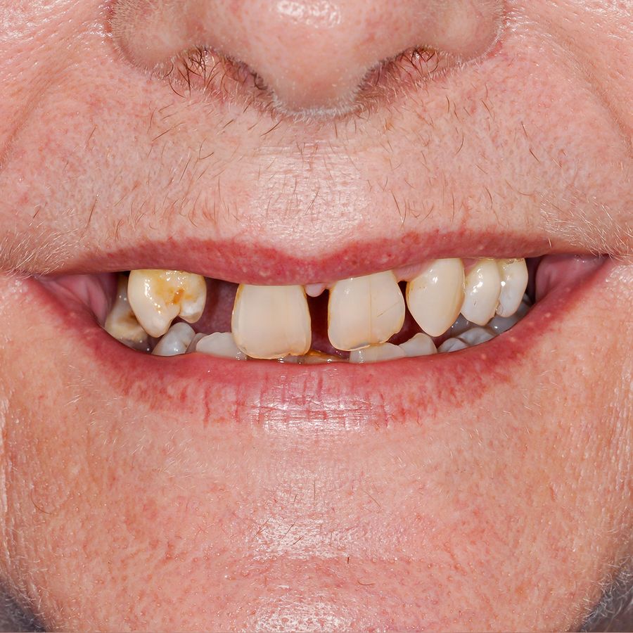 congenitally missing teeth causes
