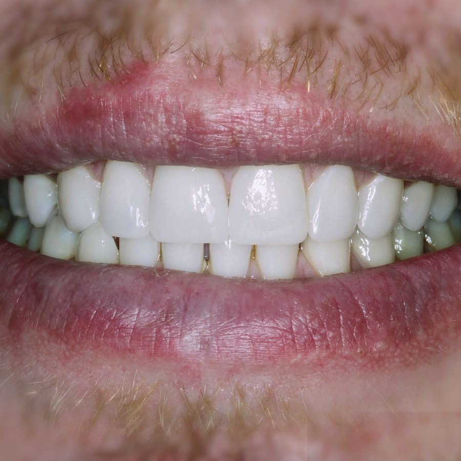 Diastema | Why Am I Getting a Gap in My Front Teeth? // 3Dental