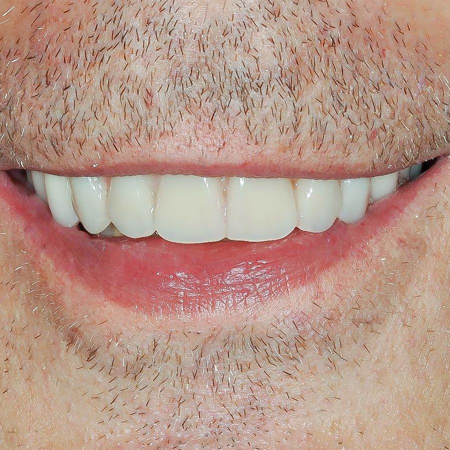 titanium implants side effects