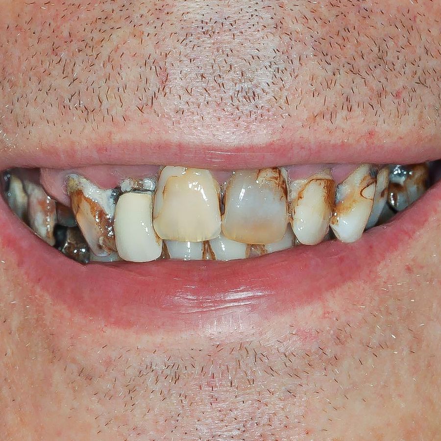 titanium implants side effects