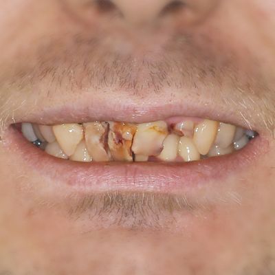 Dental Bridge | Procedure // 3Dental In Dublin, Limerick & Galway ...