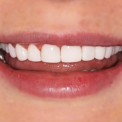 Dental Cosmetic Bonding | Tooth Bonding // 3Dental In Dublin, Limerick ...