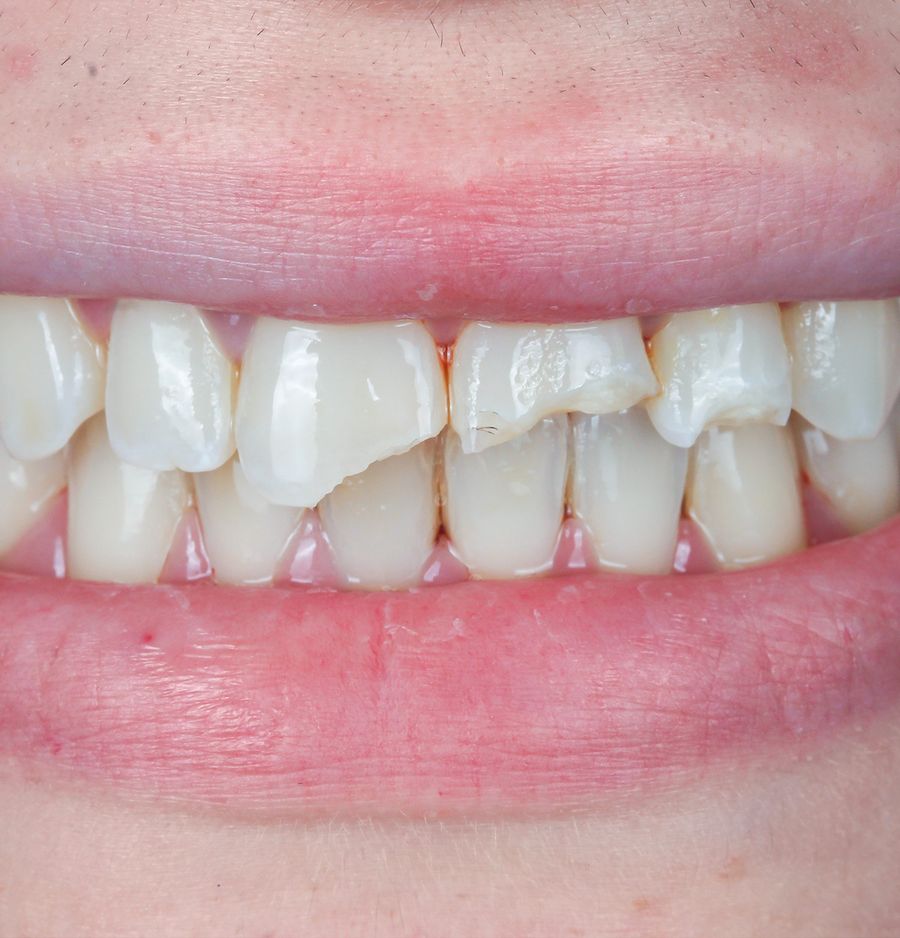 chipped front tooth