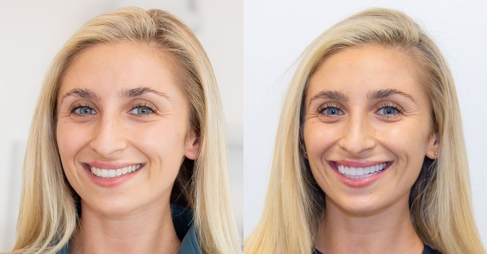 Composite Bonding Before & After // 3Dental