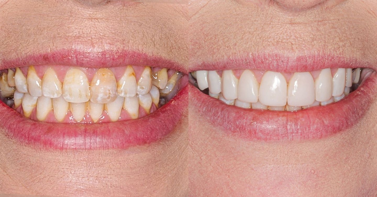 Composite Bonding Before & After // 3Dental