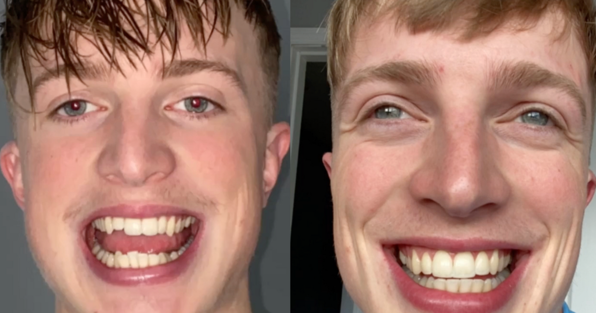overbite braces progress
