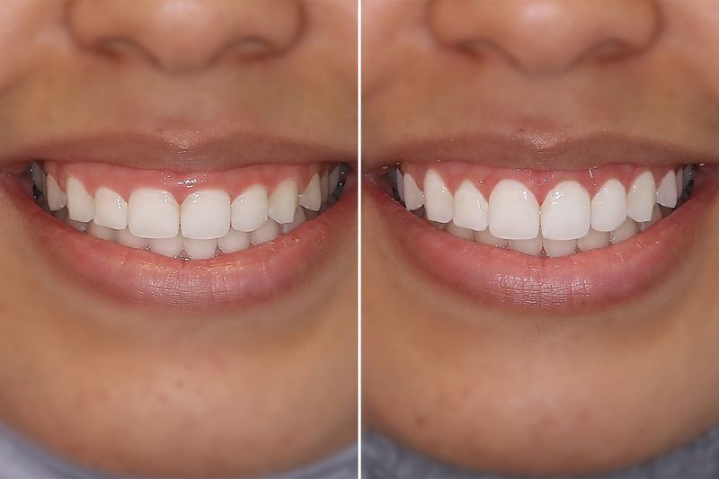 Gingivectomy Procedure | Gum Dental Surgery // 3Dental