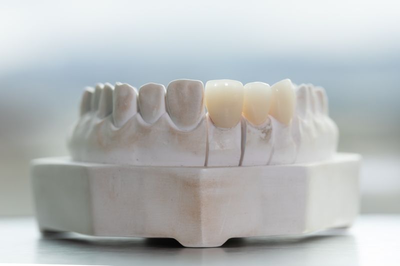 Dental Bridge | Procedure // 3Dental In Dublin, Limerick & Galway ...