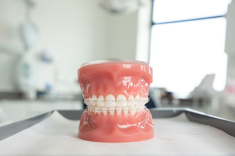 ceramic braces fitting