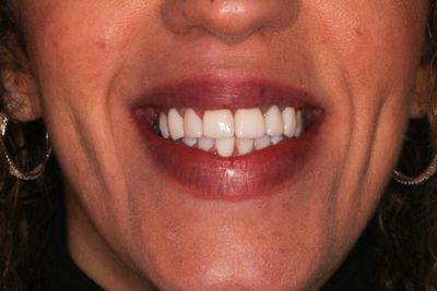 Gum Surgery | Gum Disease Treatments // 3Dental