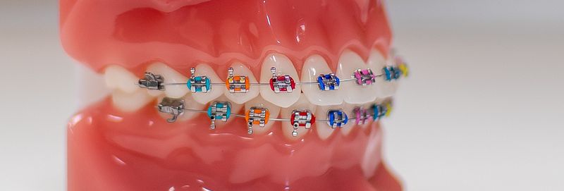 braces colors examples
