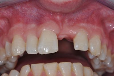 Dental Implants | Procedure & Reviews // 3Dental In Dublin, Limerick ...