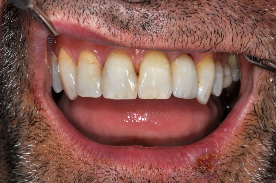 Dental Implants Price List | Dental Implant Cost