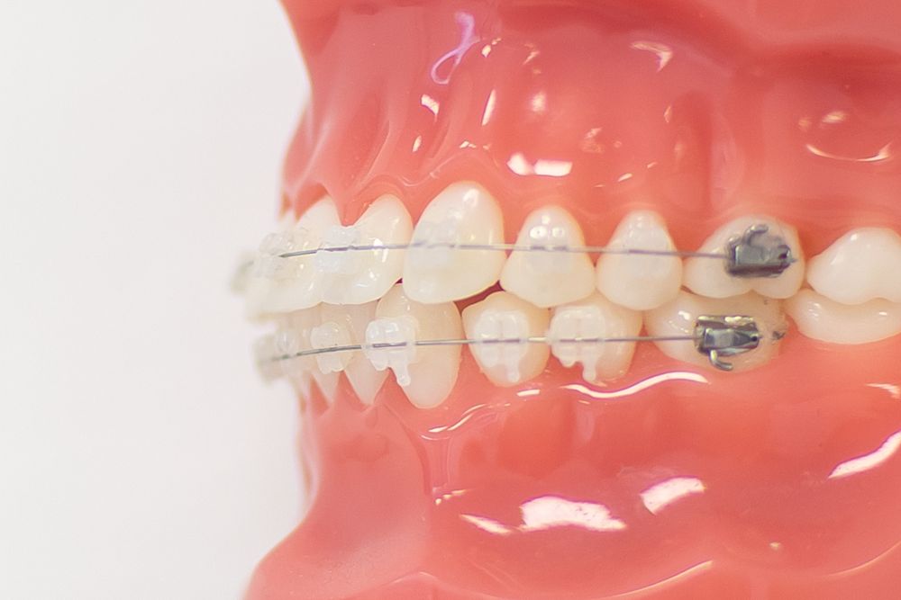 Malocclusion of Teeth - Diagnosis and Orthodontic Treatment
