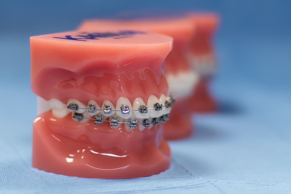 Hypodontia (Missing Teeth): Treatment and Causes // 3Dental